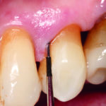 Perisolv - removes biofilm periodontitis, mucositits, peri-implantitis