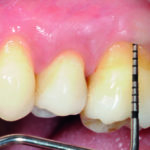 Perisolv - removes biofilm periodontitis, mucositits, peri-implantitis