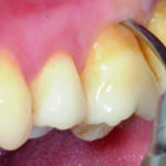 Perisolv - removes biofilm periodontitis, mucositits, peri-implantitis