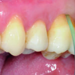 Perisolv - removes biofilm periodontitis, mucositits, peri-implantitis