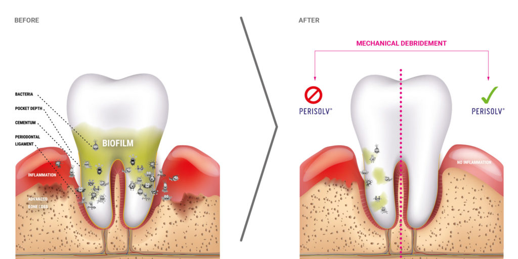 Perisolv - removes biofilm periodontitis, mucositits, peri-implantitis